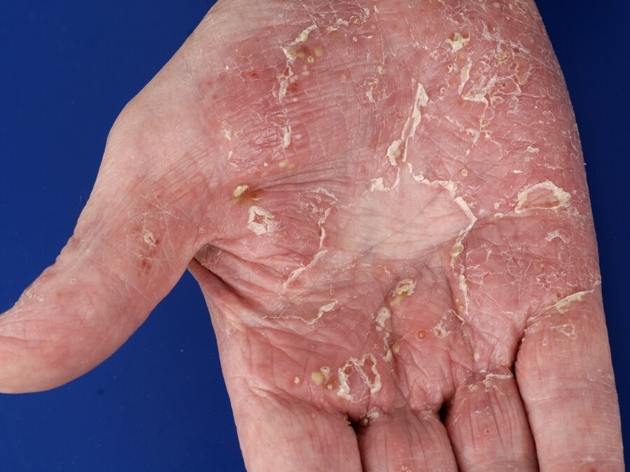 掌蹠膿疱症の中医治療 - 天王寺こいでクリニック 心療内科・神経内科・栄養療法